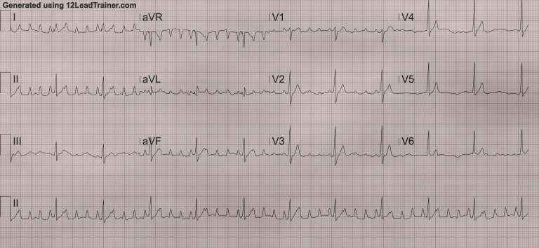 Ritmos Cardíacos Normales y Anormales – Parte 1 - ECCtrainings
