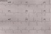 Bigeminismo Ventricular: Clave en la Interpretación del ECG Clínico ...